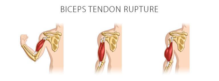 Biceps Tendon Rupture Overview - Orlando Hand Surgery Associates