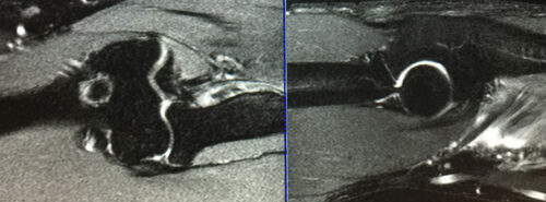 Bicep Tendon Rupture Surgery - Overview - Preparation - Procedure