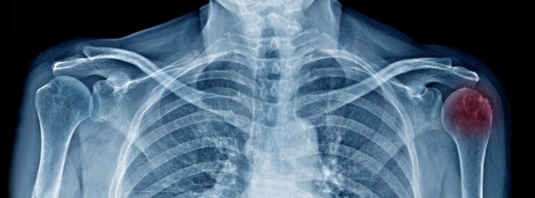 Frozen Shoulder Surgery - Frozen Shoulder Pain - Orlando Hand Surgery ...