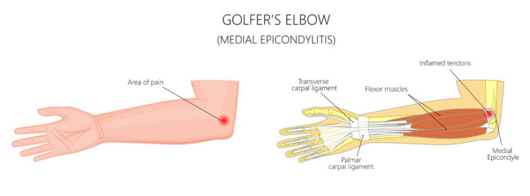 Golfer’s Elbow - Condition - Nonsurgical Treatment - Orlando Hand ...