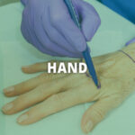 Patient Surgeries - Hand Surgeries - Orlando Hand Surgery Associates