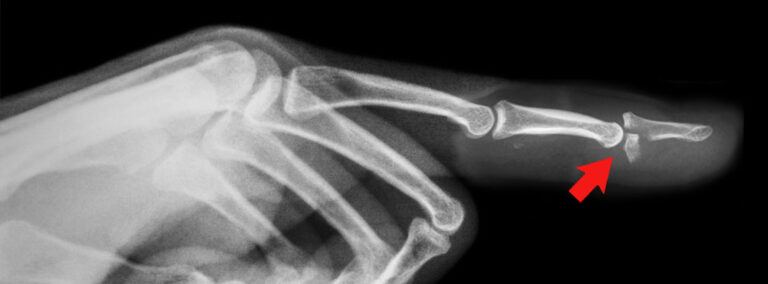 Jersey Finger Surgery - Overview - Preparation - Procedure