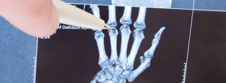 Rheumatoid Arthritis Surgery - Orlando Hand Surgery Specialists | Wrist ...