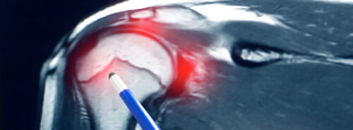 Rotator Cuff Tear Surgery - Overview - Preparation - Procedure