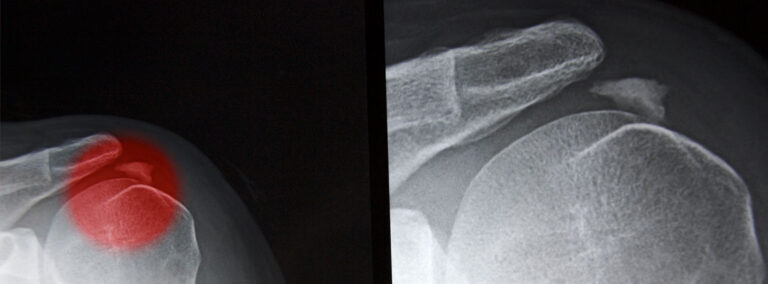 Rotator Cuff Tendonitis Surgery - Overview - Preparation - Procedure