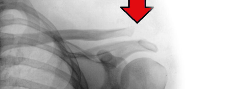 Shoulder Separation - Overview - Nonsurgical Options