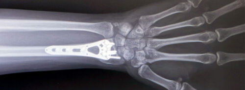 Wrist Surgeries - Orlando Hand Surgery Associates