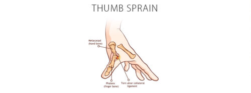 Thumb Sprains - Condition - Nonsurgical Options - Orlando Hand Surgery ...